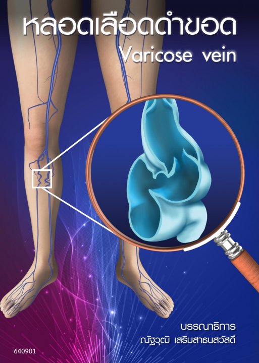 หลอดเลือดดำขอด (VARICOSE VEIN) | ศูนย์หนังสือจุฬาฯ